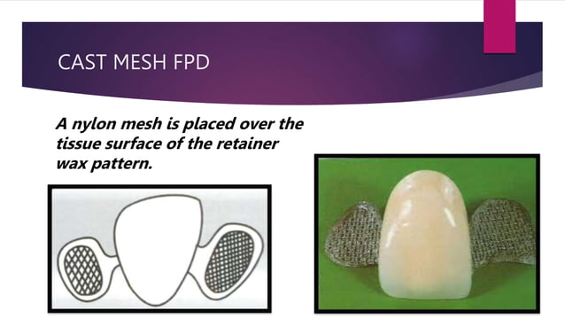 Resin bonded FPD | PPTX | Dental Health | Diseases and Conditions