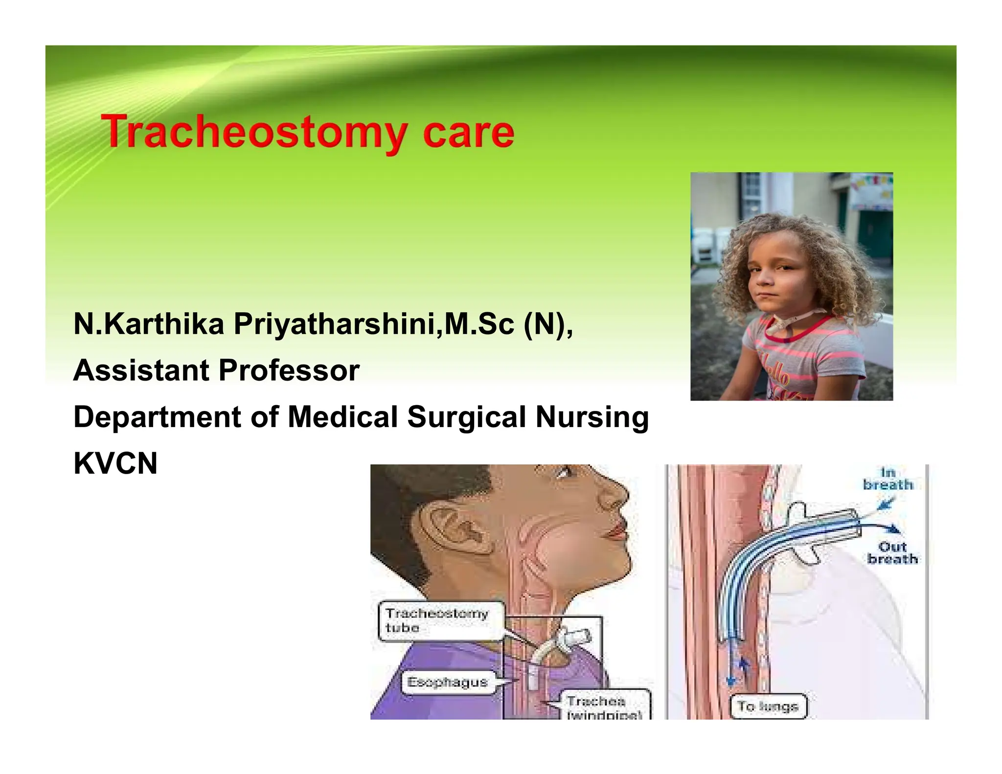 PPT-TRACHEOSTOMY.pdfkkkkjjjjjjjjjjjjjhhhhhh | PDF