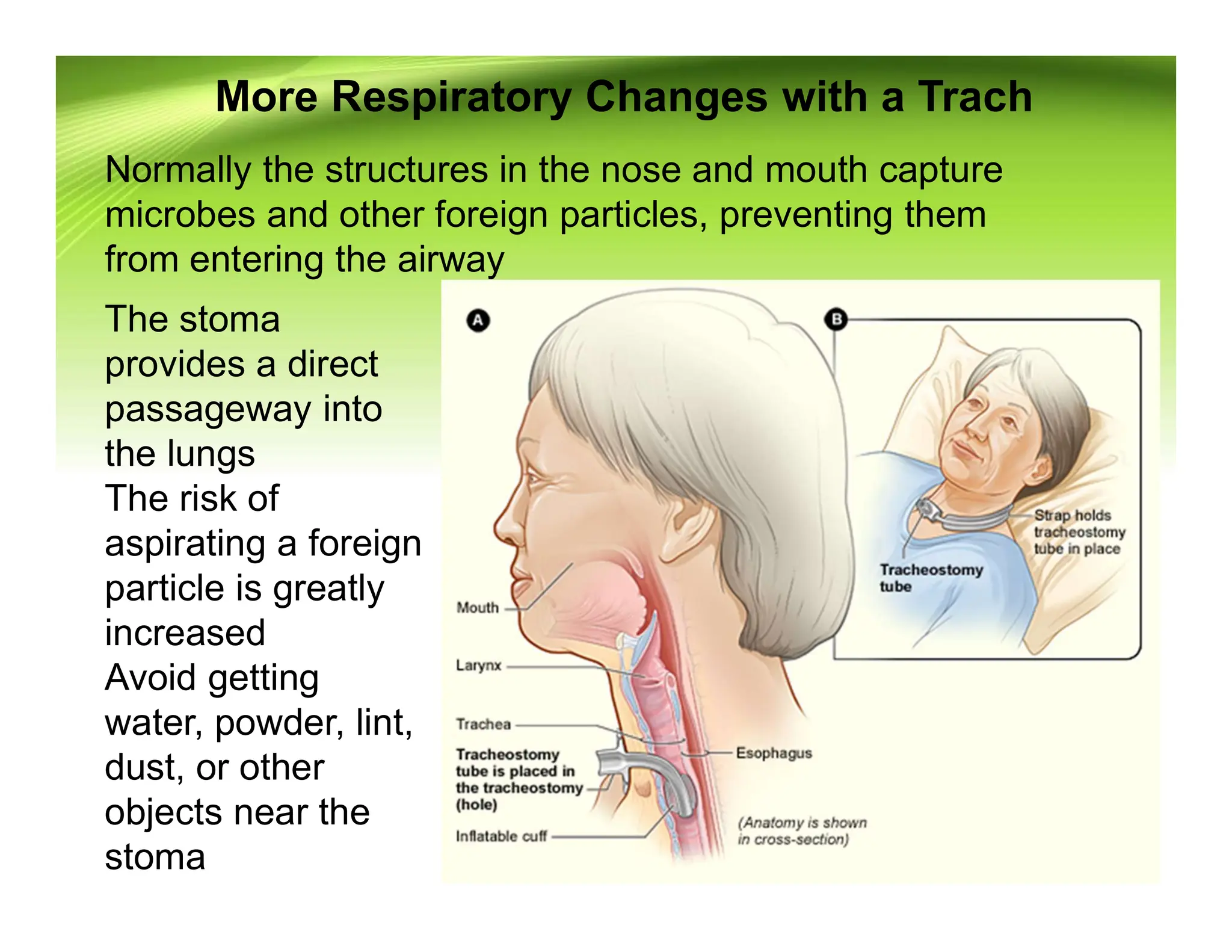 PPT-TRACHEOSTOMY.pdfkkkkjjjjjjjjjjjjjhhhhhh | PDF