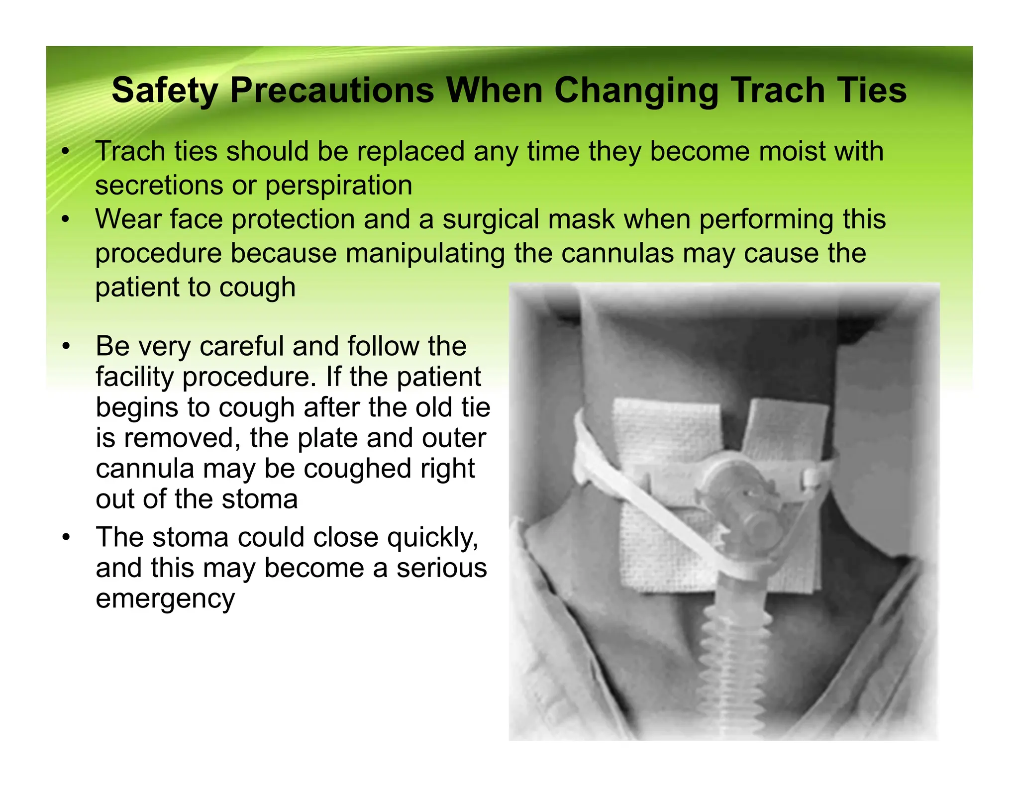 PPT-TRACHEOSTOMY.pdfkkkkjjjjjjjjjjjjjhhhhhh | PDF
