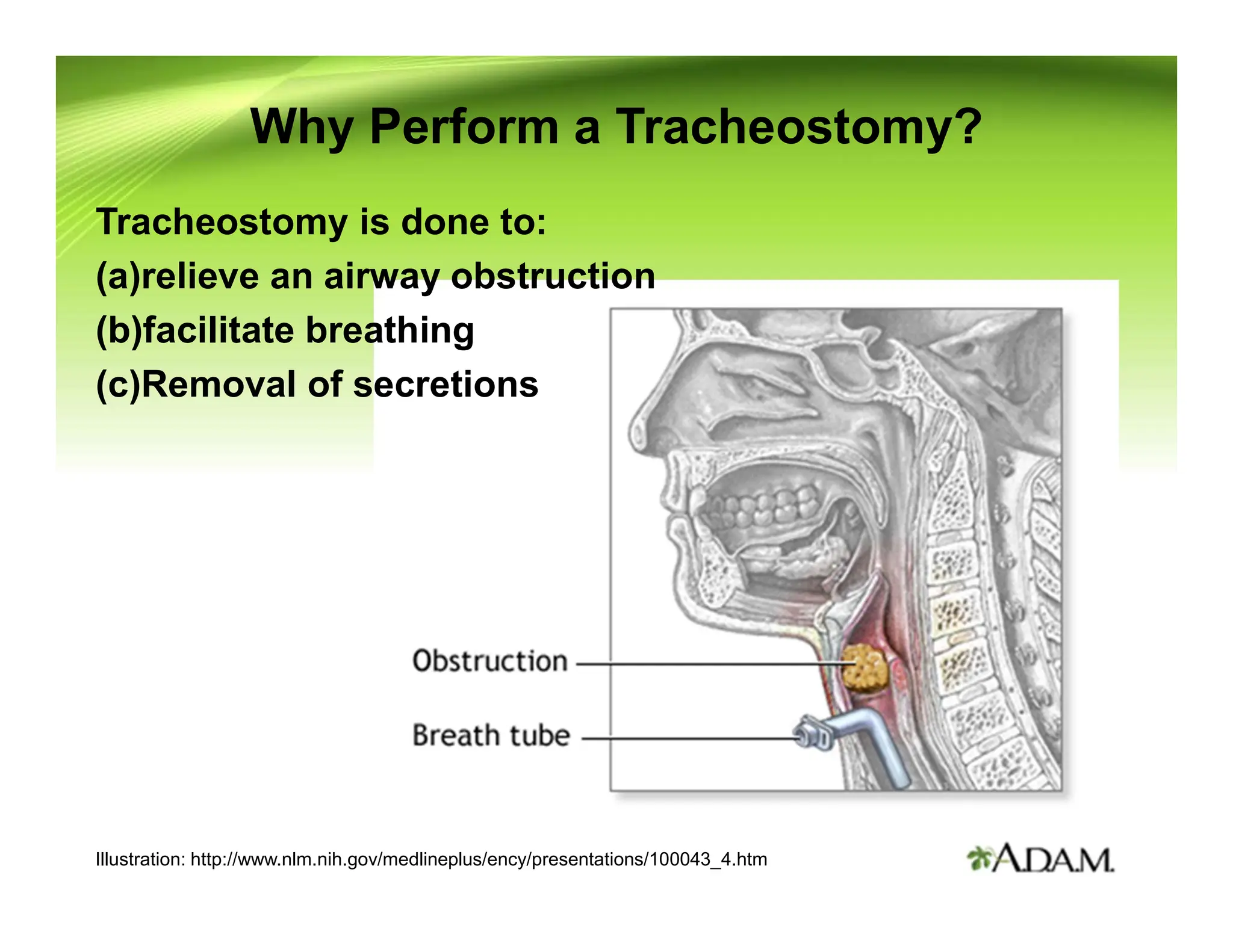 PPT-TRACHEOSTOMY.pdfkkkkjjjjjjjjjjjjjhhhhhh | PDF