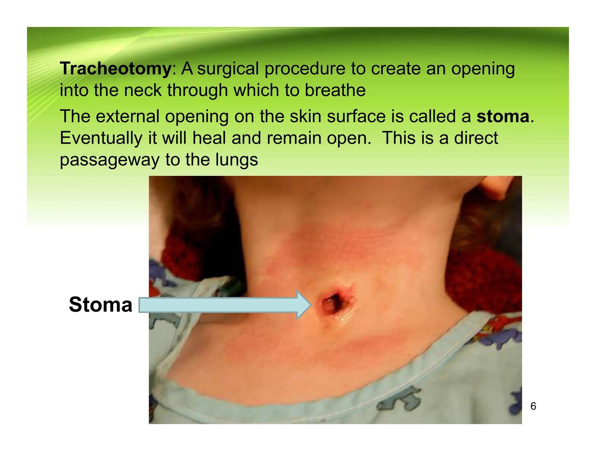 PPT-TRACHEOSTOMY.pdfkkkkjjjjjjjjjjjjjhhhhhh | PDF