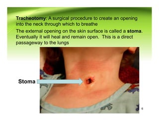PPT-TRACHEOSTOMY.pdfkkkkjjjjjjjjjjjjjhhhhhh | PDF