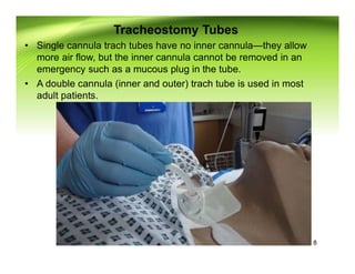 PPT-TRACHEOSTOMY.pdfkkkkjjjjjjjjjjjjjhhhhhh | PDF