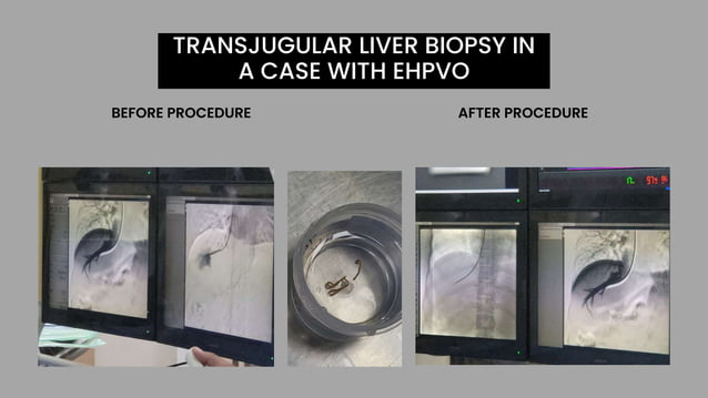 Transjugular Liver Biopsy in a Case with EHPVO.pptx