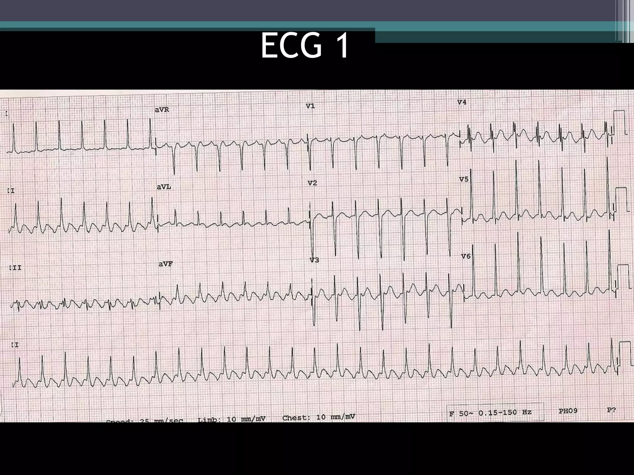 ECG: Narrow Complex Tachycardia | PPT