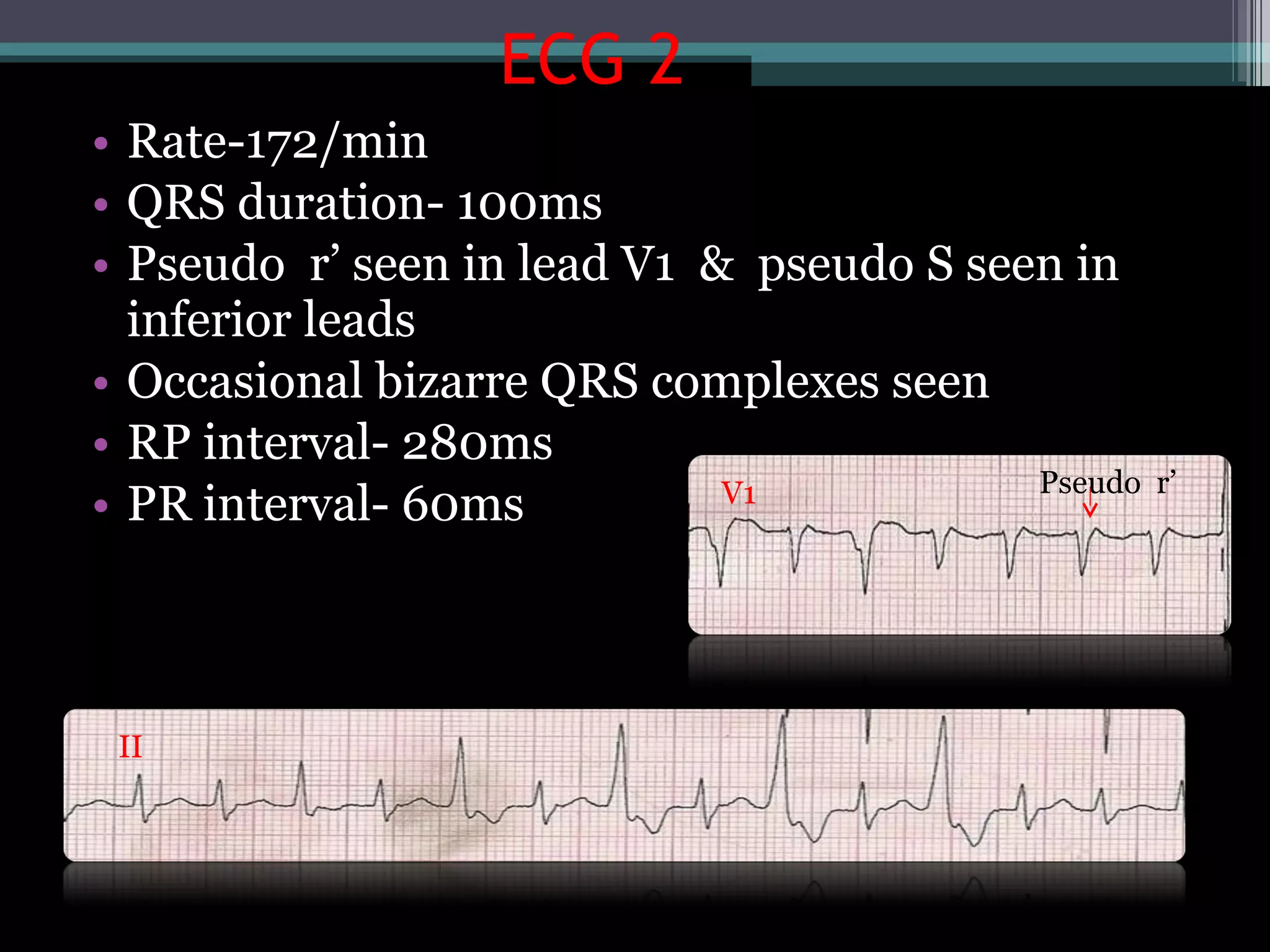 ECG: Narrow Complex Tachycardia | PPT