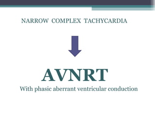 ECG: Narrow Complex Tachycardia | PPT