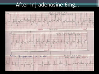 ECG: Narrow Complex Tachycardia | PPT