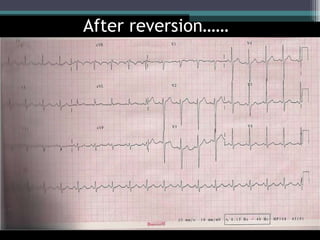 ECG: Narrow Complex Tachycardia | PPT