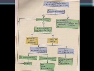 ECG: Narrow Complex Tachycardia | PPT