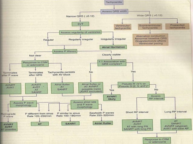 ECG: Narrow Complex Tachycardia | PPT