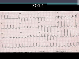 ECG: Narrow Complex Tachycardia | PPT