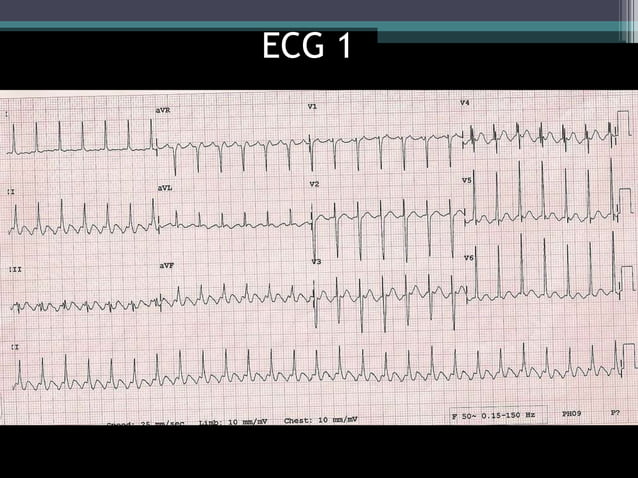 ECG: Narrow Complex Tachycardia | PPT