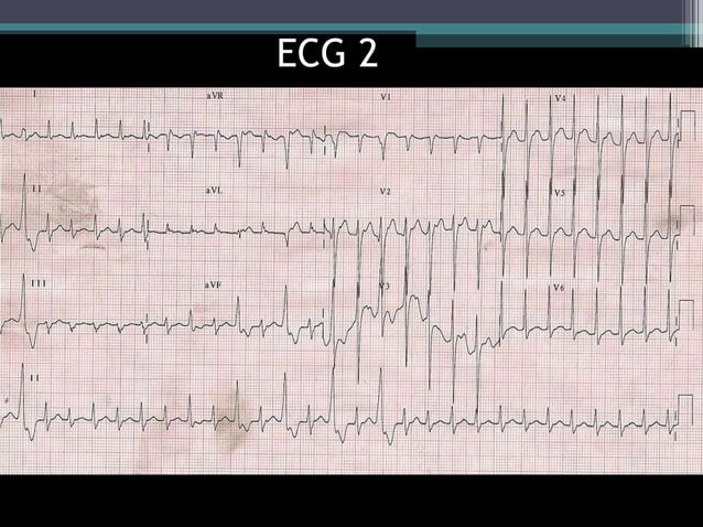 ECG: Narrow Complex Tachycardia | PPT