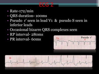 ECG: Narrow Complex Tachycardia | PPT