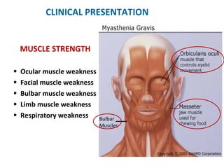 Myasthenia Gravis - Pathophysiology, Cl. Features, DD | PPT