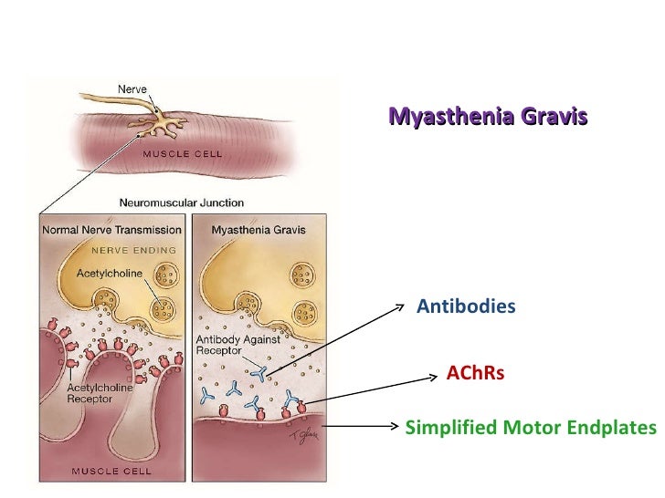 Myasthenia Gravis - Pathophysiology, Cl. Features, DD