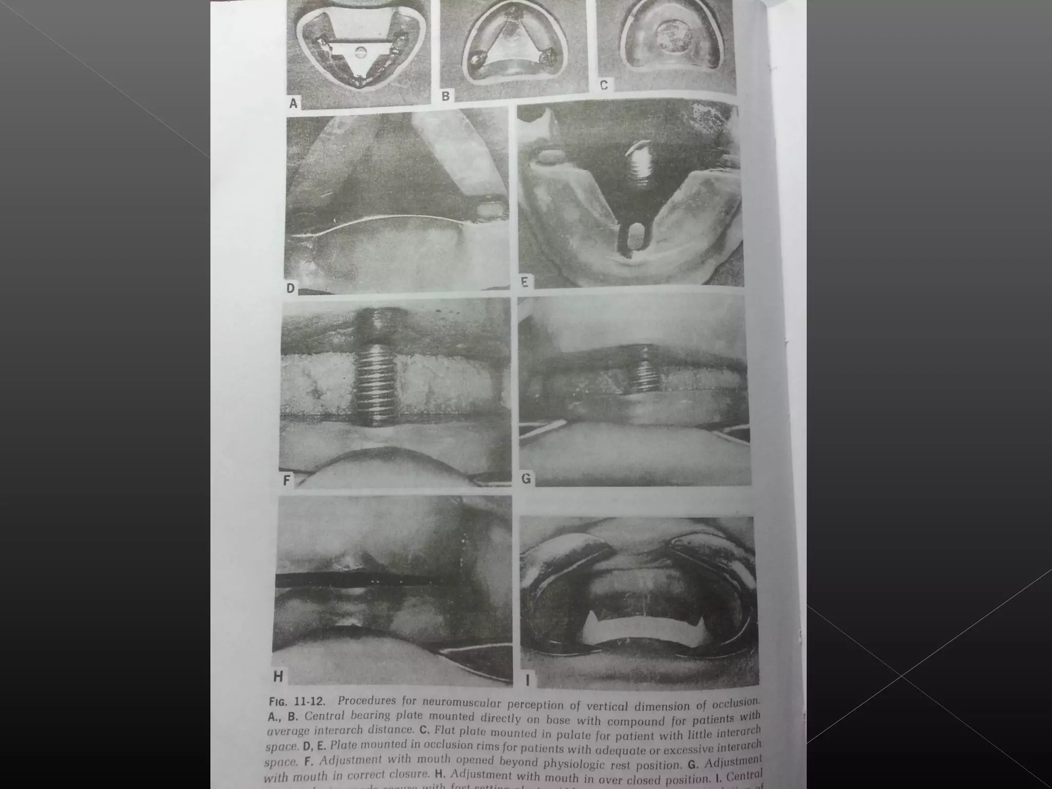 vertical jaw relation | PPT