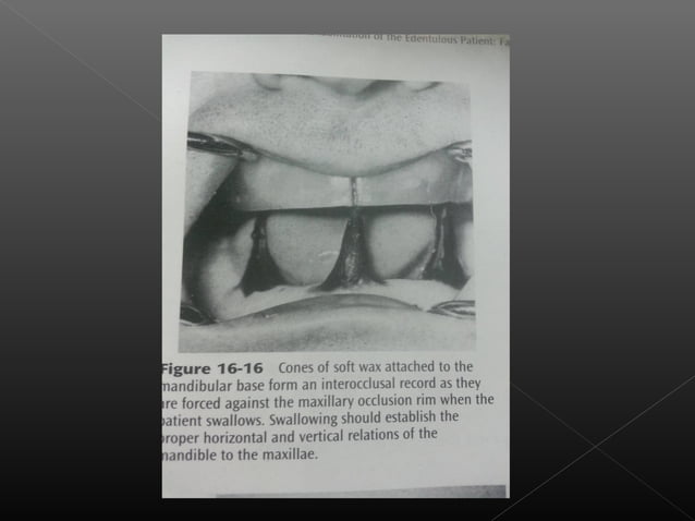 vertical jaw relation | PPT