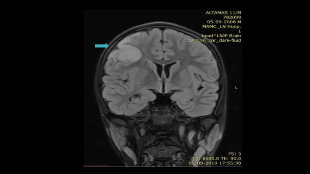 MR IMAGING IN STROKE | PPT