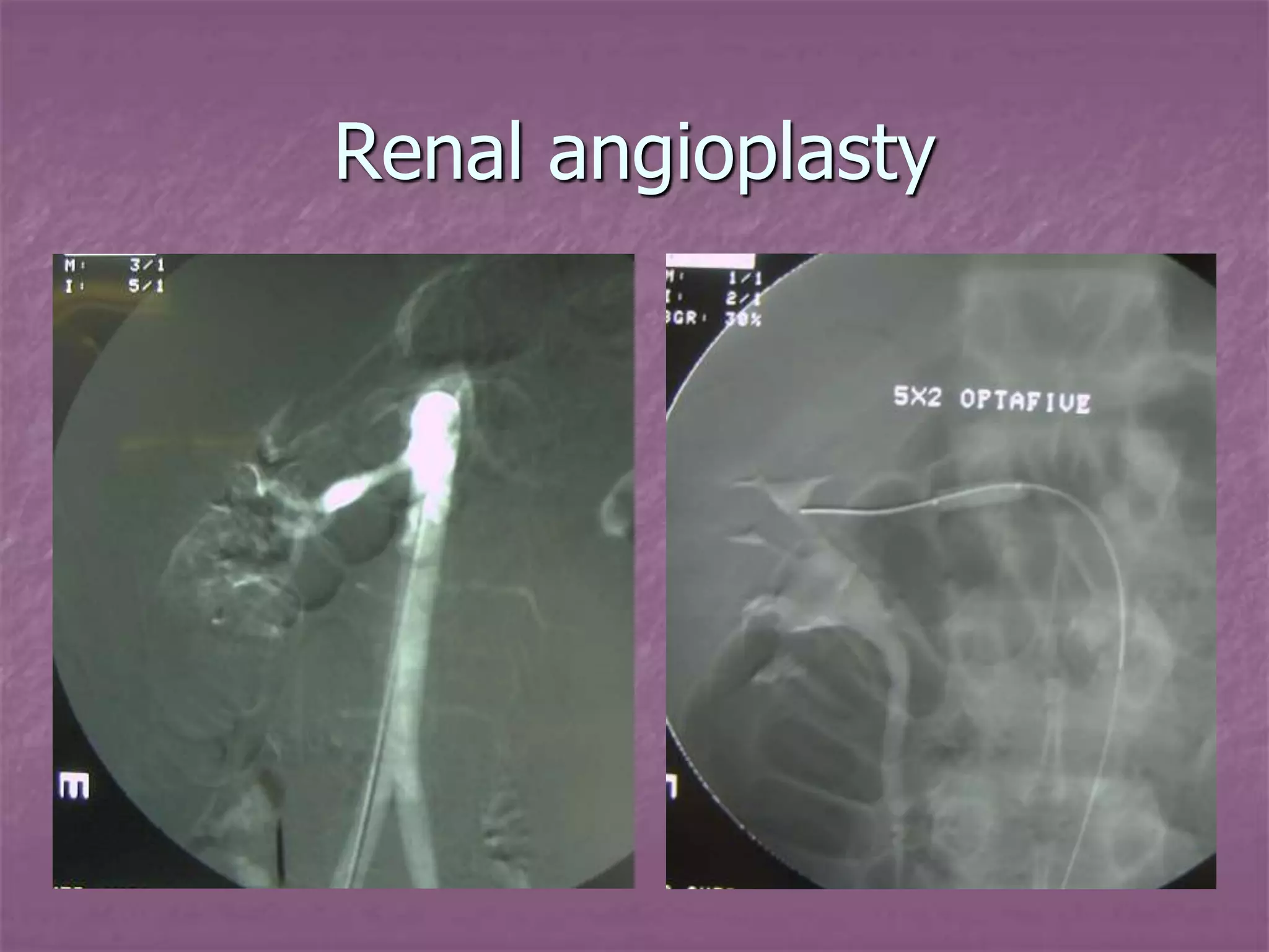 Introduction to Interventional Radiology.pptx