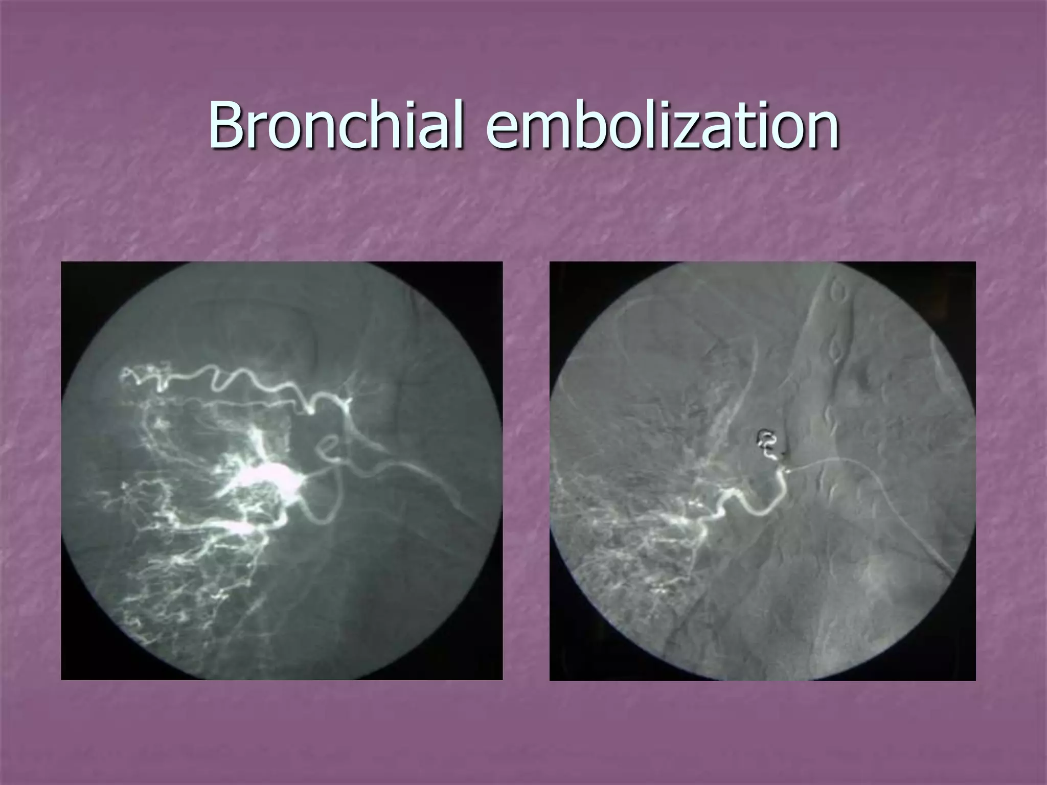 Introduction to Interventional Radiology.pptx
