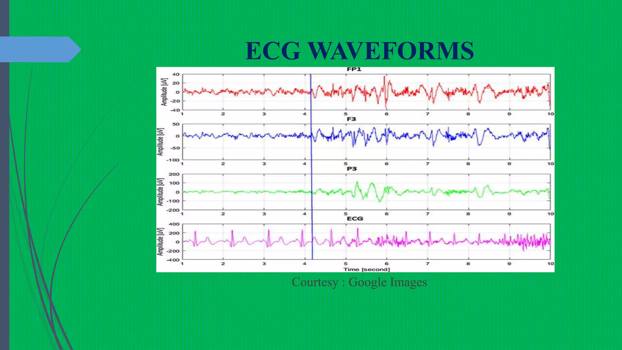 ASSISTIVE SYSTEM FOR EPILEPSY | PPTX