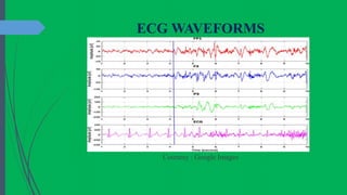 ASSISTIVE SYSTEM FOR EPILEPSY | PPTX
