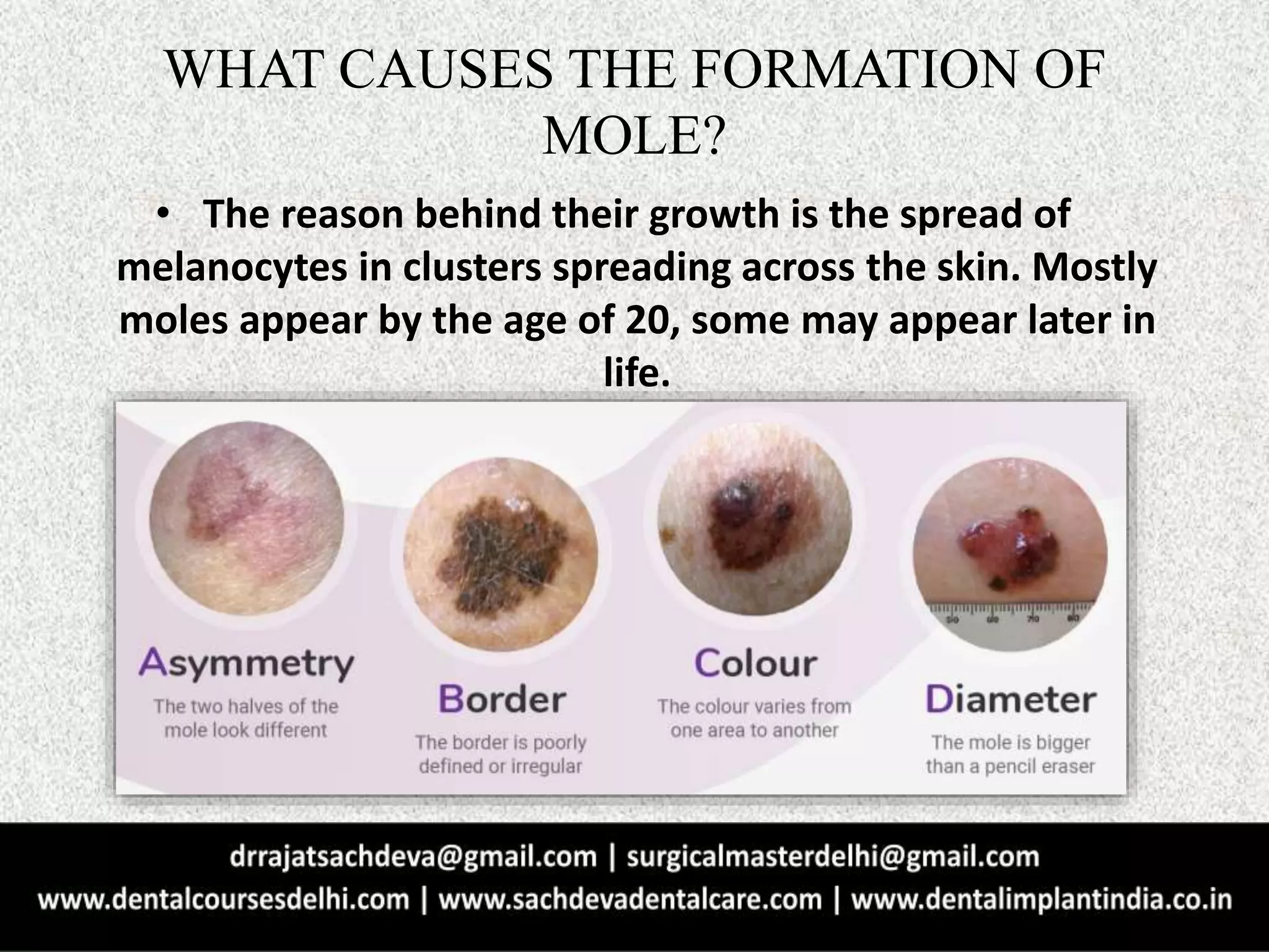 Mole removal | How to recognize if a mole is normal or suspicious ...