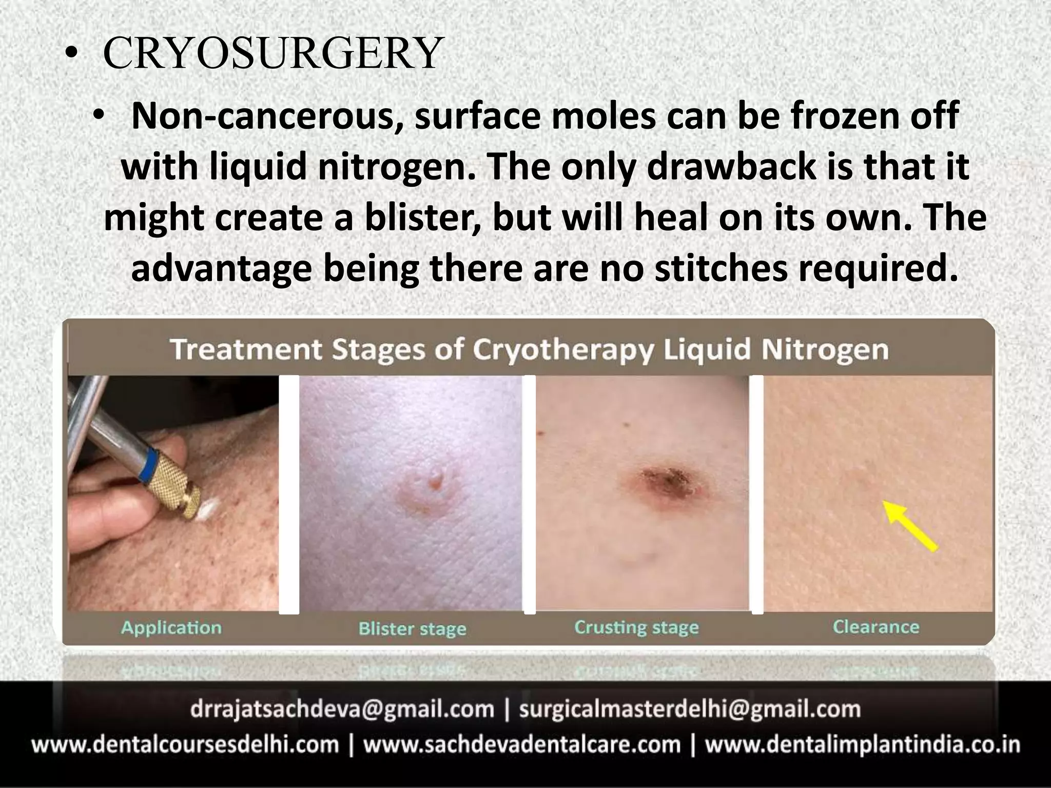 Mole removal | How to recognize if a mole is normal or suspicious ...