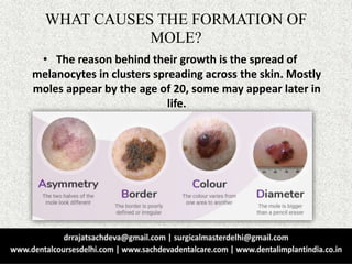 Mole removal | How to recognize if a mole is normal or suspicious ...
