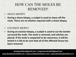 Mole removal | How to recognize if a mole is normal or suspicious ...