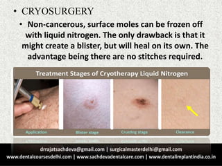 Mole removal | How to recognize if a mole is normal or suspicious ...