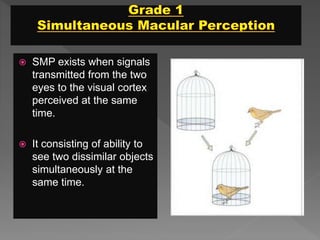 Simultaneous Macular Perception -Nayana | PPTX
