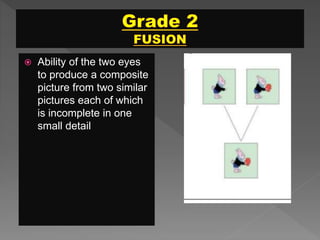 Simultaneous Macular Perception -Nayana | PPTX