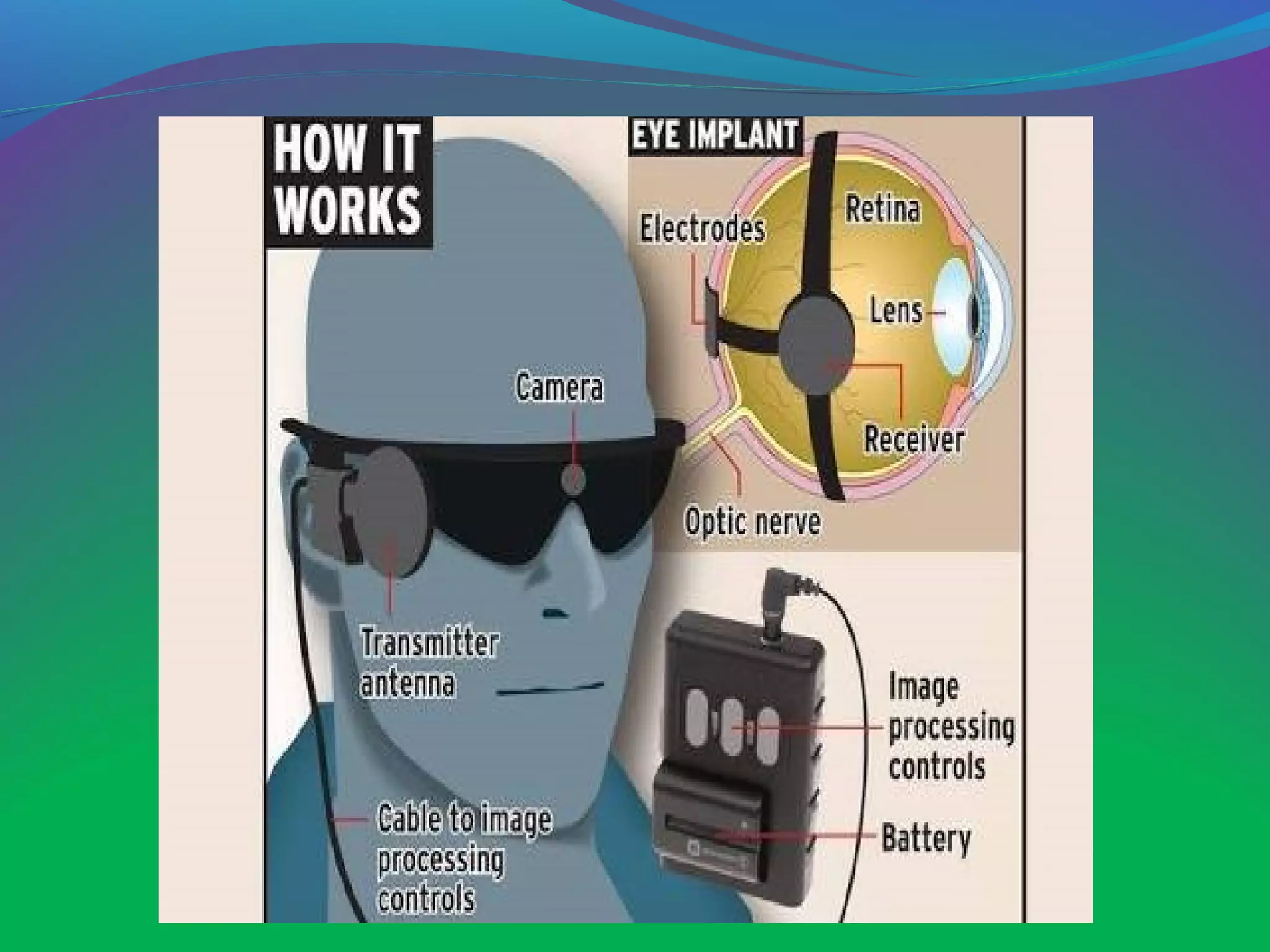 BIONIC EYE | PPT