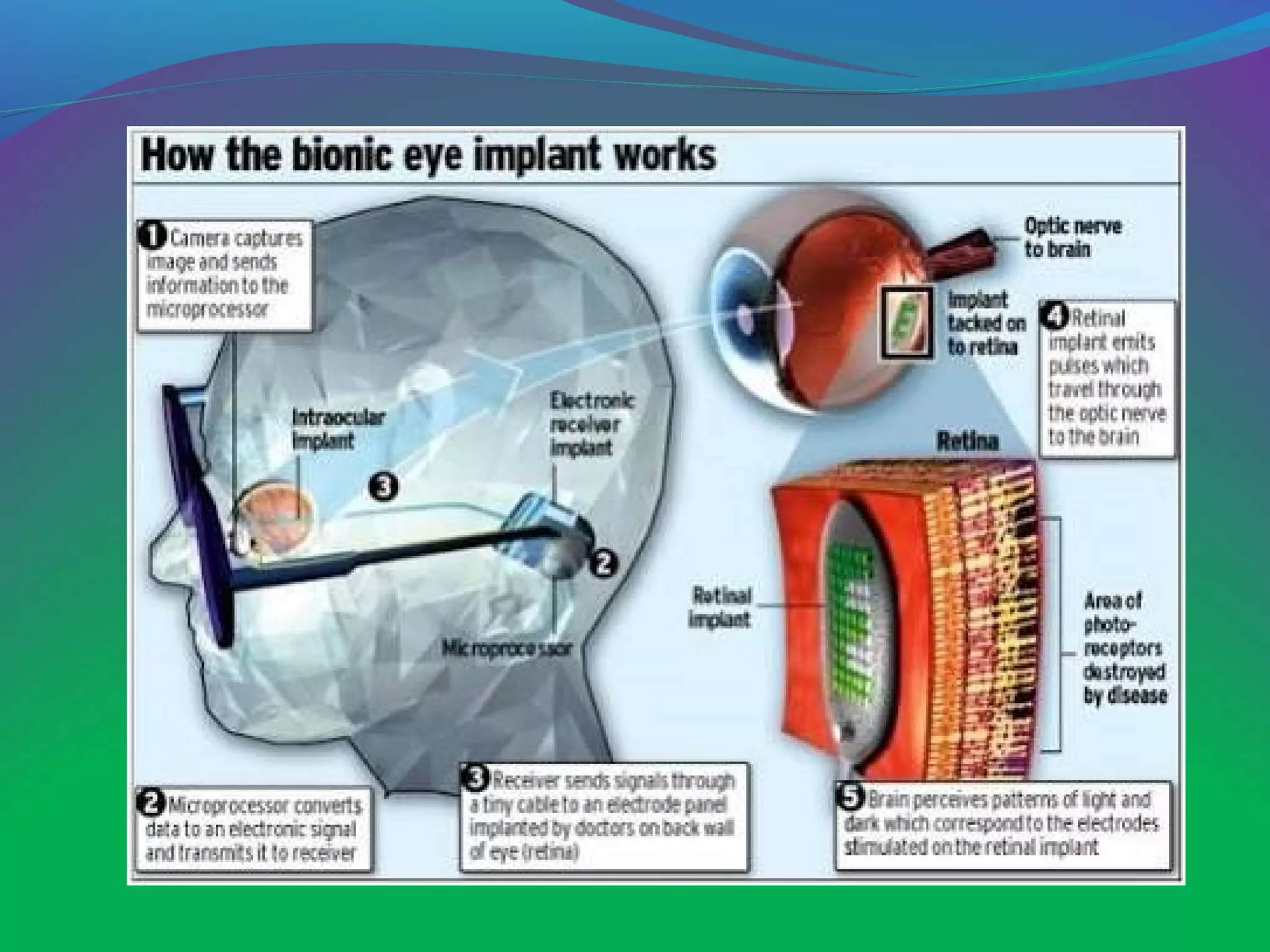 BIONIC EYE | PPT