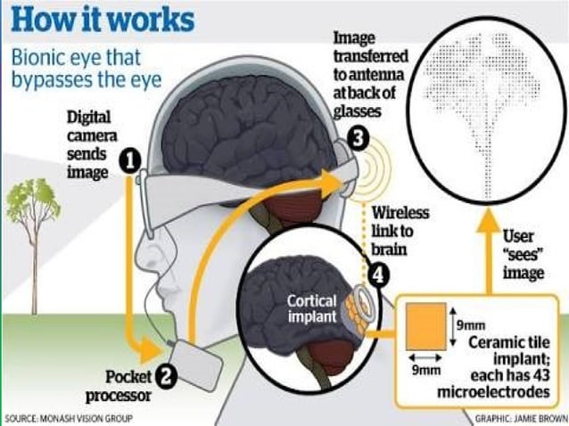 BIONIC EYE | PPT | Eye and Vision Conditions | Diseases and Conditions