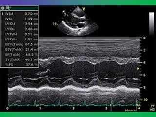 ECHOCARDIOGRAM | PPT