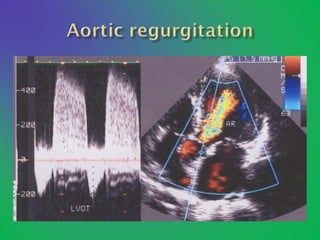 ECHOCARDIOGRAM | PPT