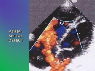 ECHOCARDIOGRAM | PPT