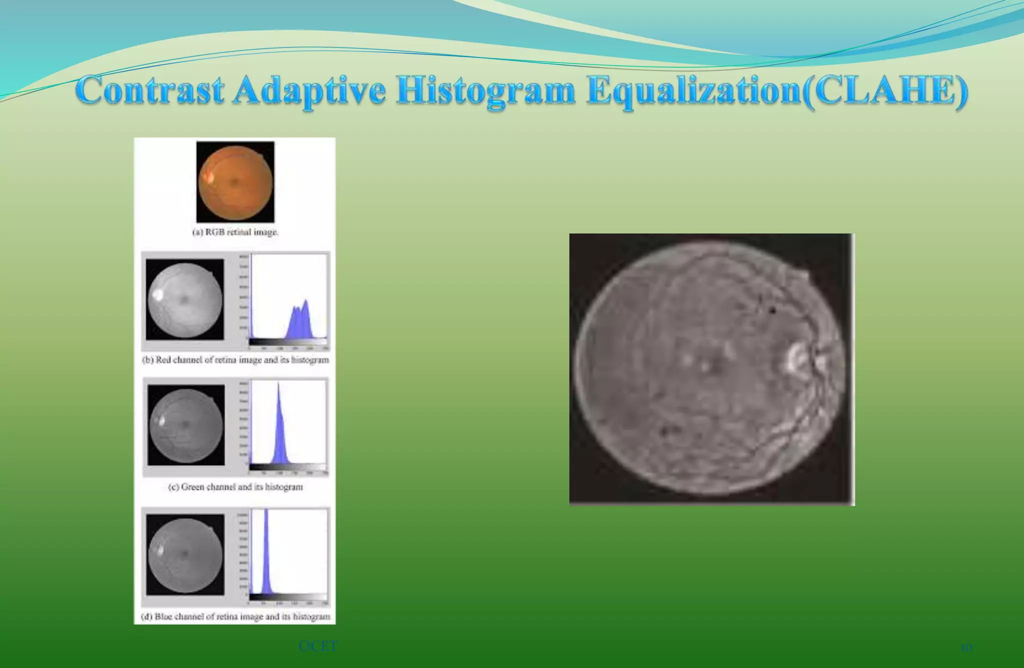 AUTOMATIC SEGMENTATION OF BLOOD VESSELS DETECTION IN RETINAL IMAGES BY USING GABOR FILTER | PPT