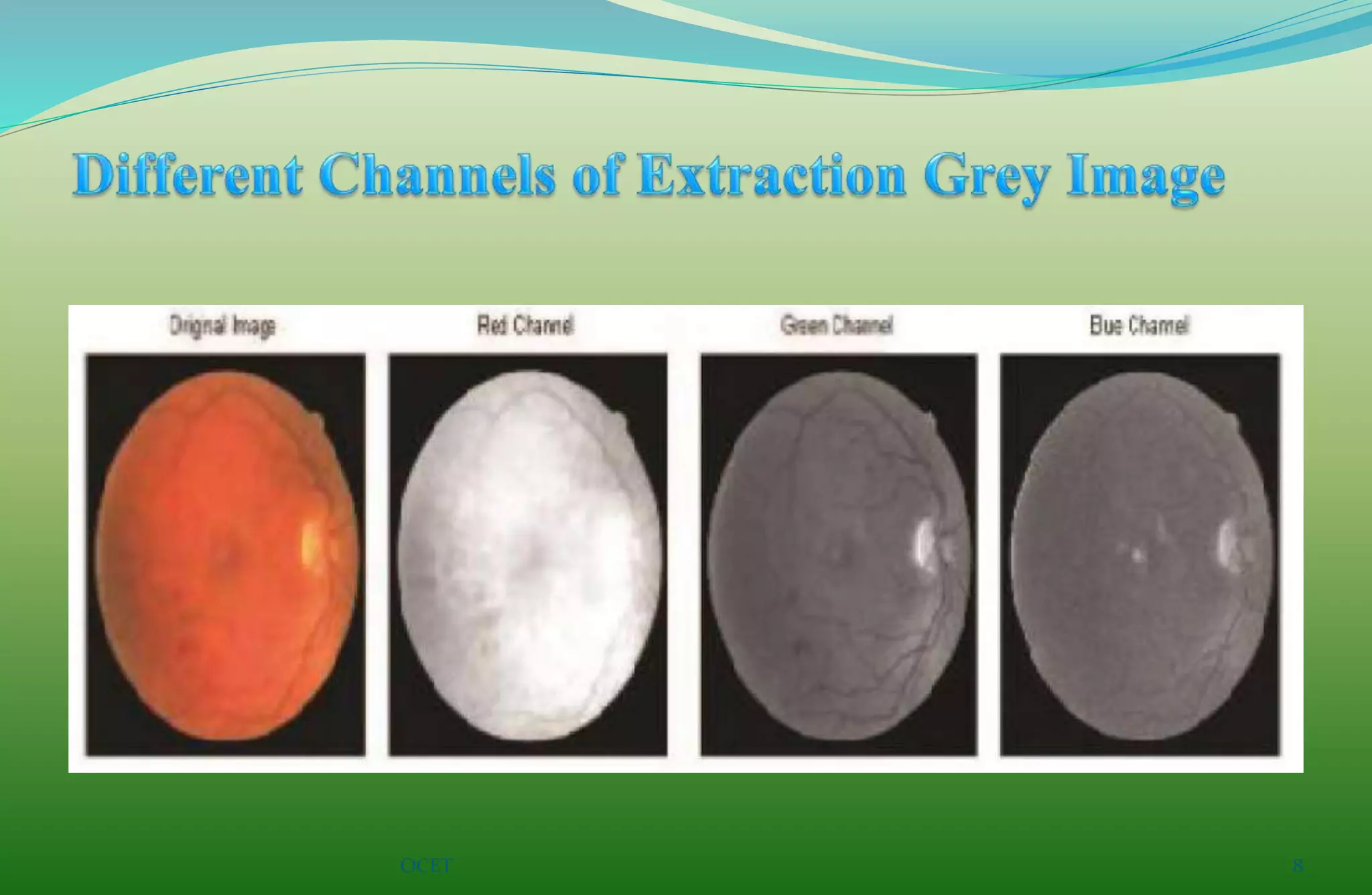 AUTOMATIC SEGMENTATION OF BLOOD VESSELS DETECTION IN RETINAL IMAGES BY USING GABOR FILTER | PPT
