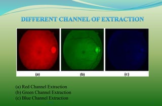 AUTOMATIC SEGMENTATION OF BLOOD VESSELS DETECTION IN RETINAL IMAGES BY ...