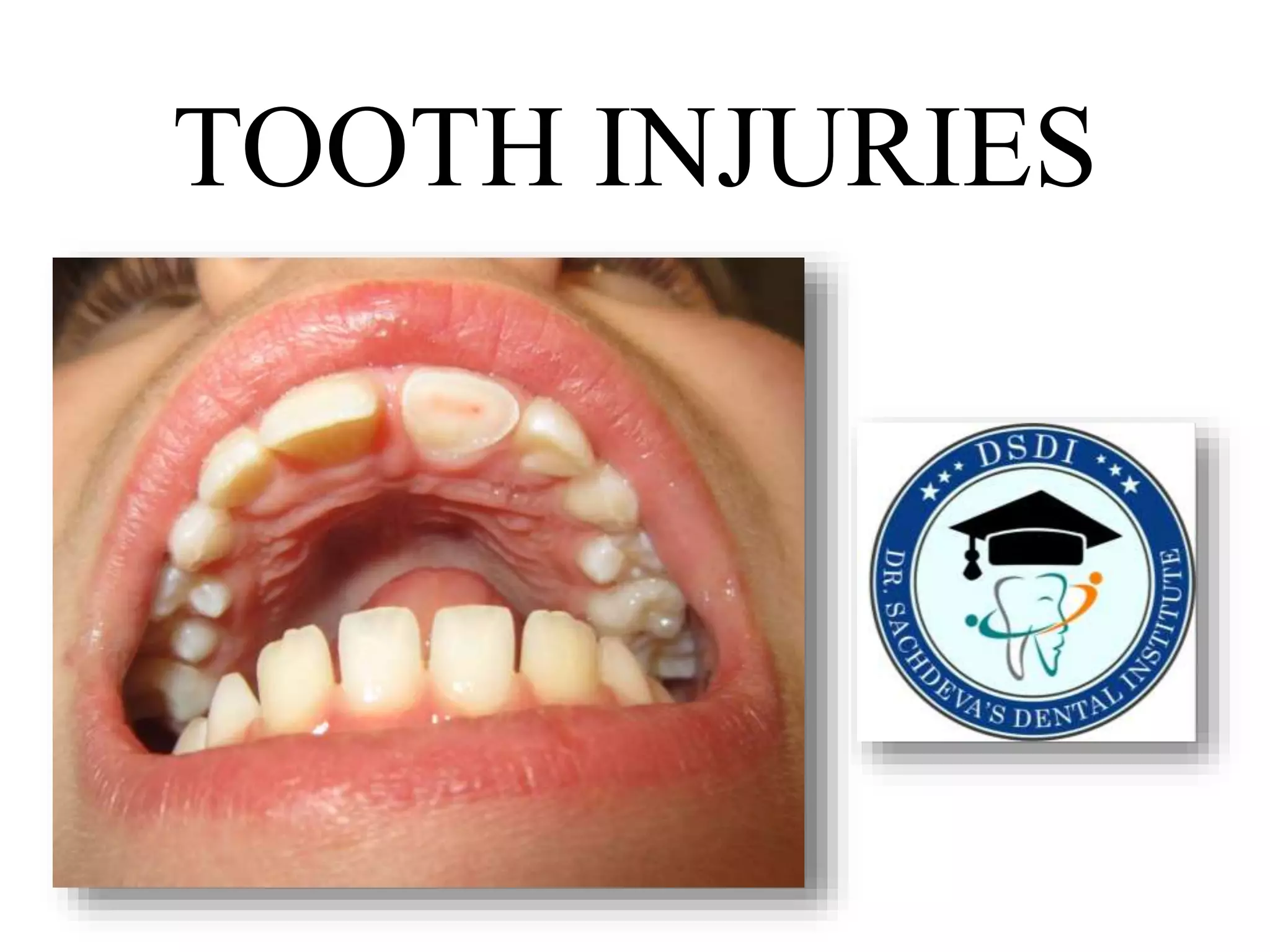 Tooth Injuries| Tooth Trauma| Treatment of Tooth Trauma | PPTX