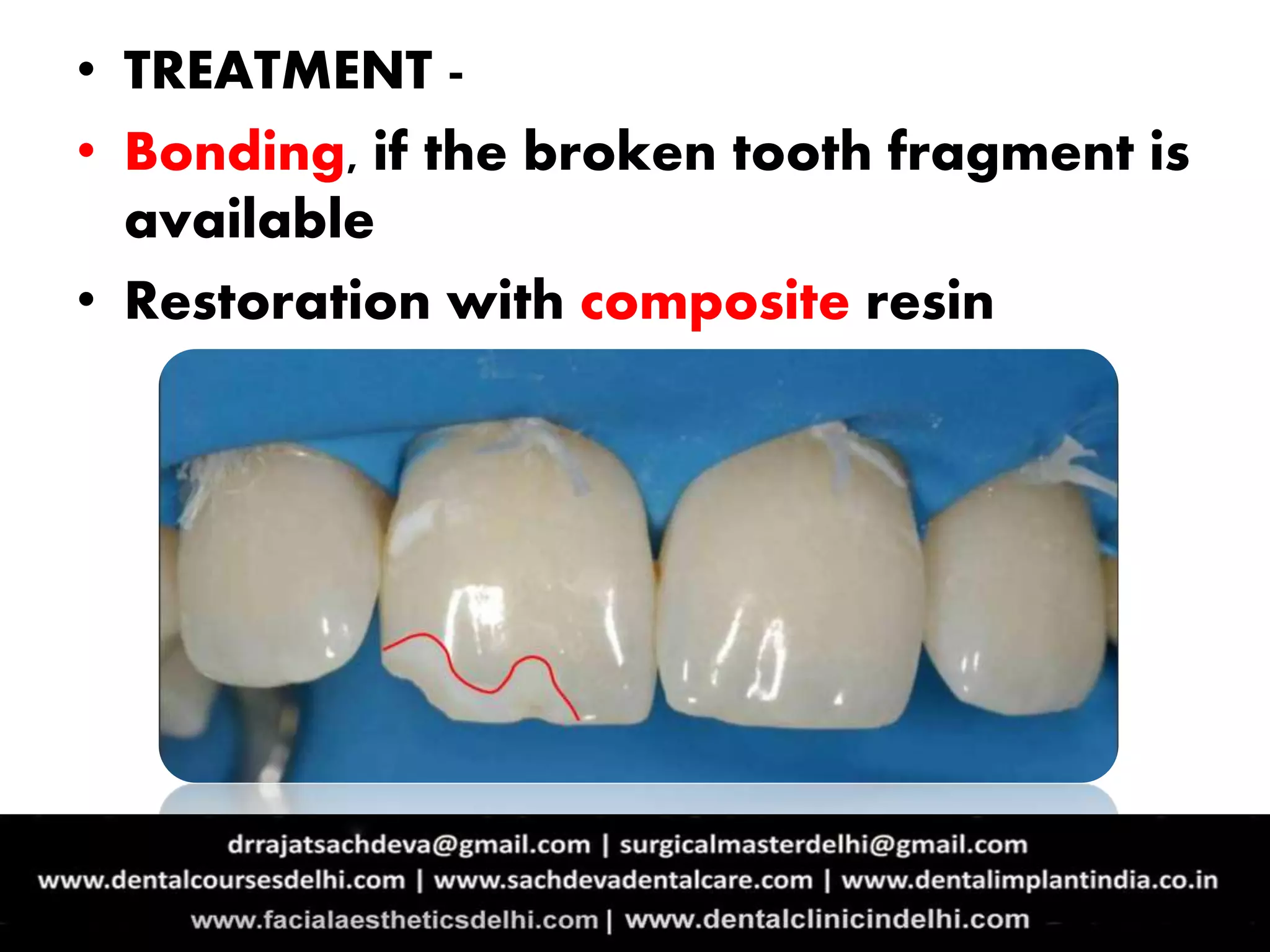 Tooth Injuries| Tooth Trauma| Treatment of Tooth Trauma | PPTX