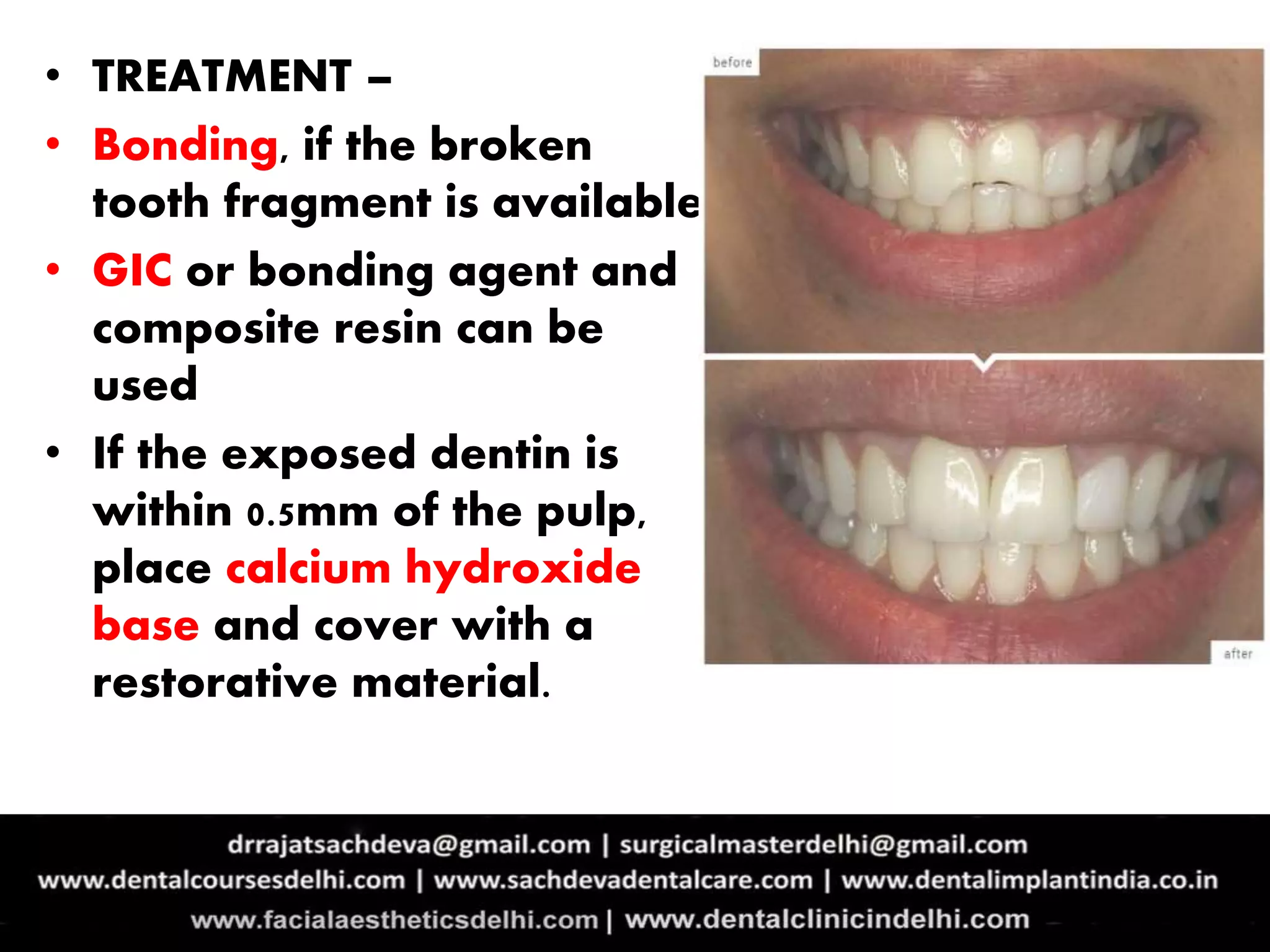 Tooth Injuries| Tooth Trauma| Treatment of Tooth Trauma | PPTX
