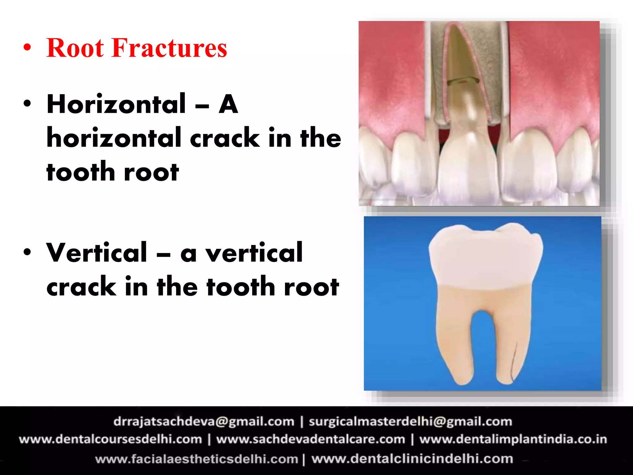 Tooth Injuries| Tooth Trauma| Treatment of Tooth Trauma | PPTX