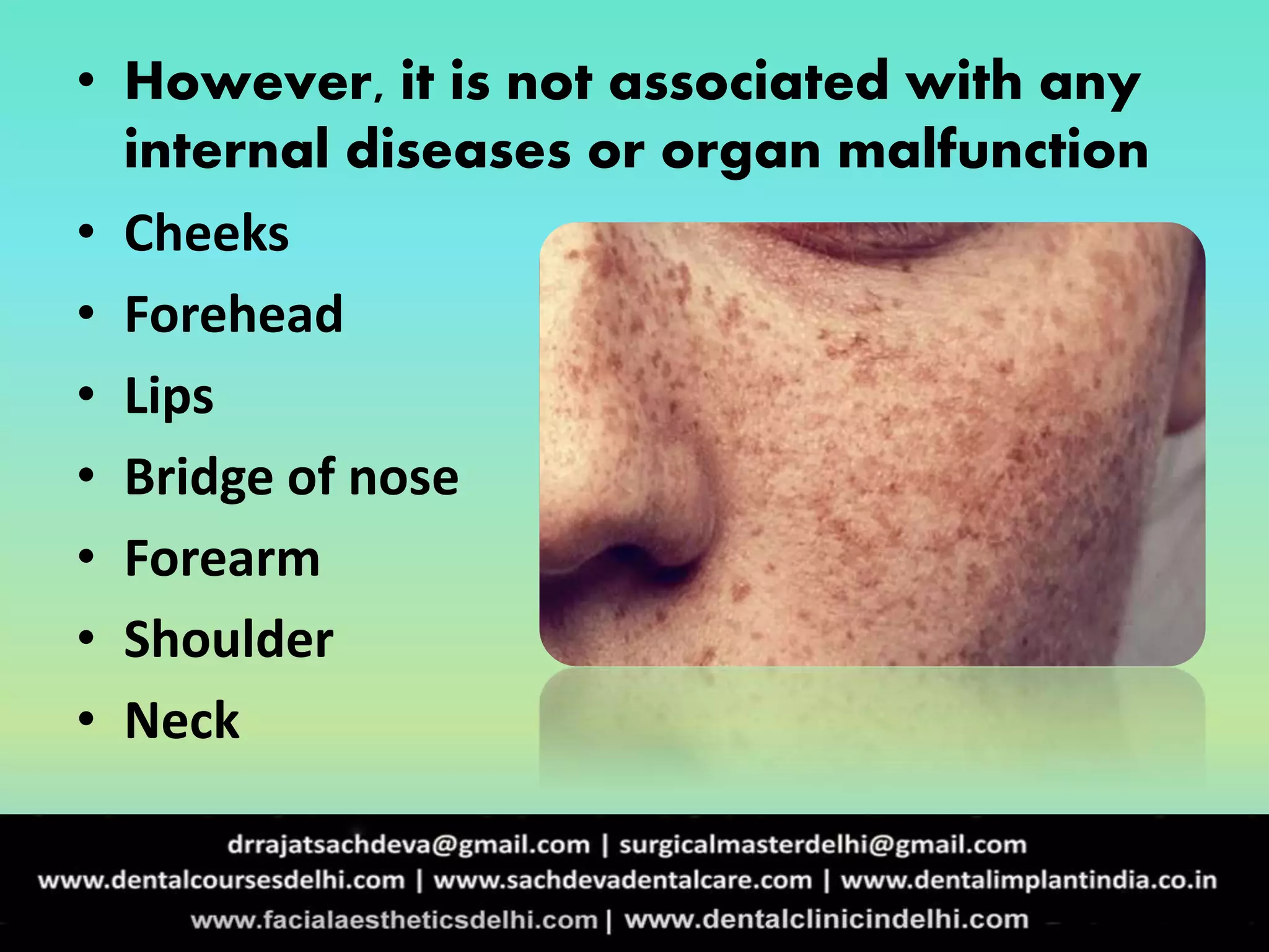 Melasma| Melasma and its Treatment| Facial Pigmentation| Post-Pregnancy ...